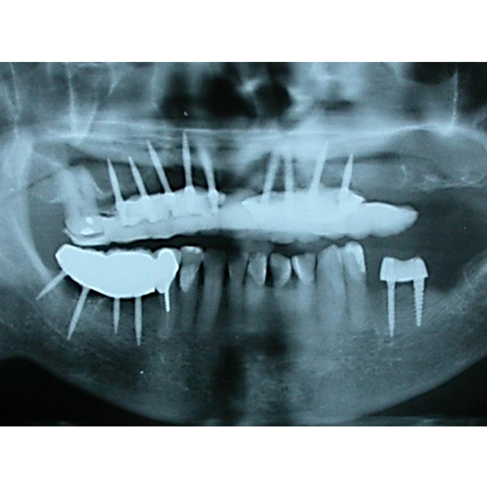 Mini Implant - Mount Elizabeth Dental Surgery™
