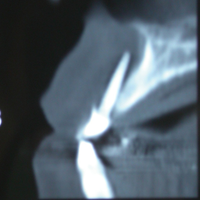 Mini Implant - Mount Elizabeth Dental Surgery™