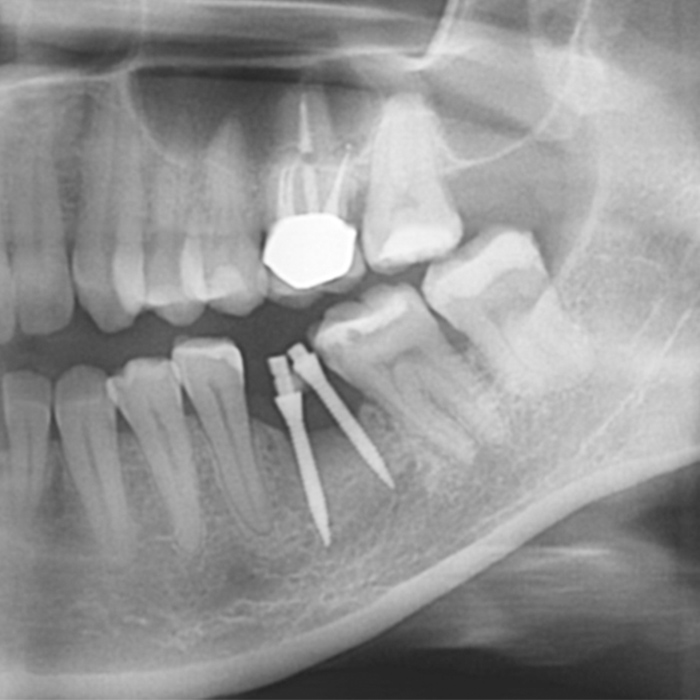 Mini Implant - Mount Elizabeth Dental Surgery™
